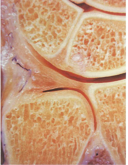 Lesão da fibrocartilagem triangular: o que é?